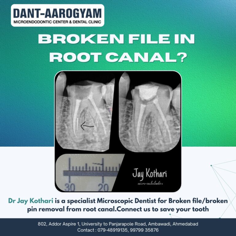 Broken File in Root Canal Treatment?? - Dant Aarogyam